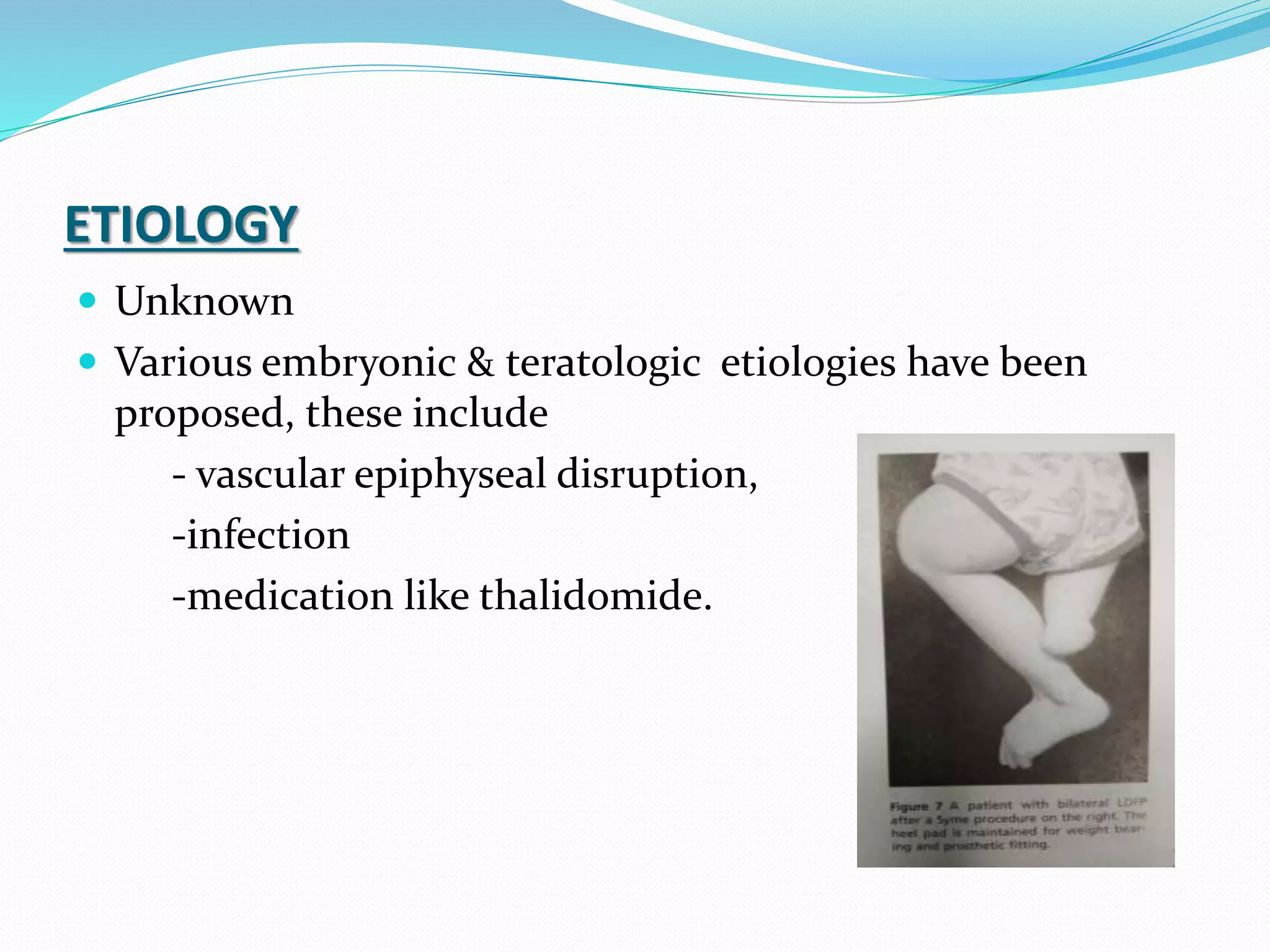 PFFD [proximal femoral focal deficiency] | PPTX