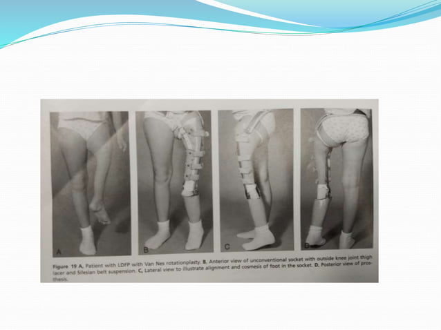 PFFD [proximal femoral focal deficiency] | PPTX