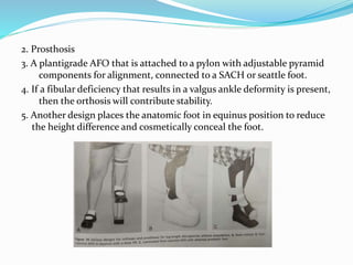 PFFD [proximal femoral focal deficiency] | PPTX
