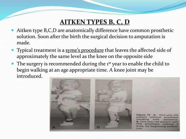 PFFD [proximal femoral focal deficiency] | PPTX