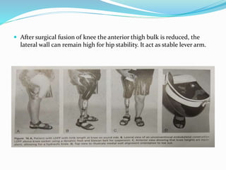 PFFD [proximal femoral focal deficiency] | PPTX