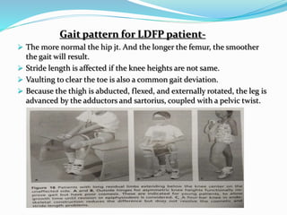 PFFD [proximal femoral focal deficiency] | PPTX