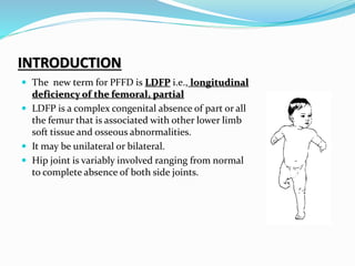 PFFD [proximal femoral focal deficiency] | PPTX