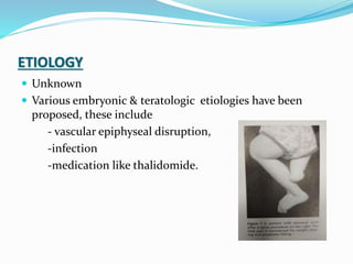 PFFD [proximal femoral focal deficiency] | PPTX