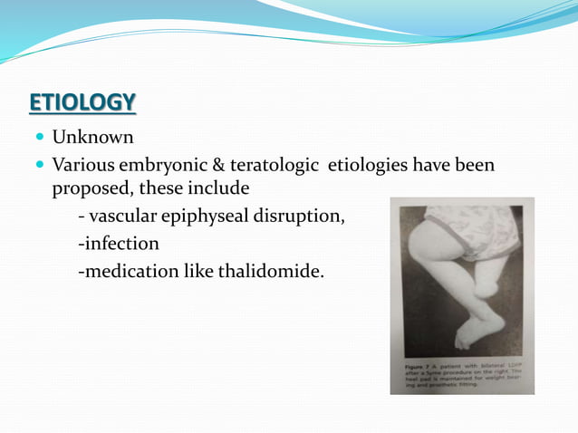 PFFD [proximal femoral focal deficiency] | PPTX