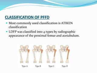 PFFD [proximal femoral focal deficiency] | PPTX