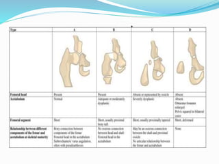 PFFD [proximal femoral focal deficiency] | PPTX