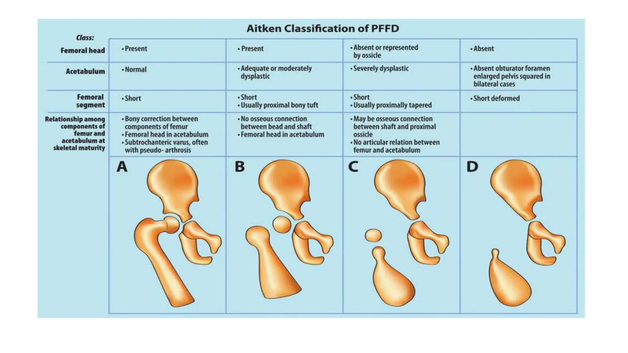 PFFD ie proximal femoral focal deficiency | PPTX