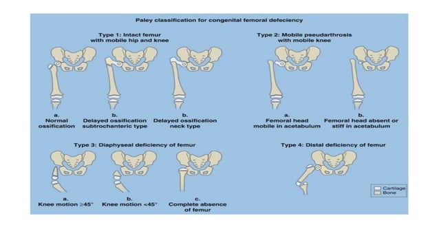 PFFD ie proximal femoral focal deficiency | PPTX | Death, Injury, or ...