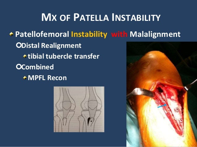 MPFL. PFJ Instability2015