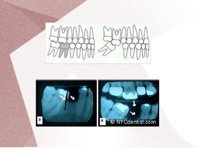 Extraction Of The First Permanent Molar | PPT