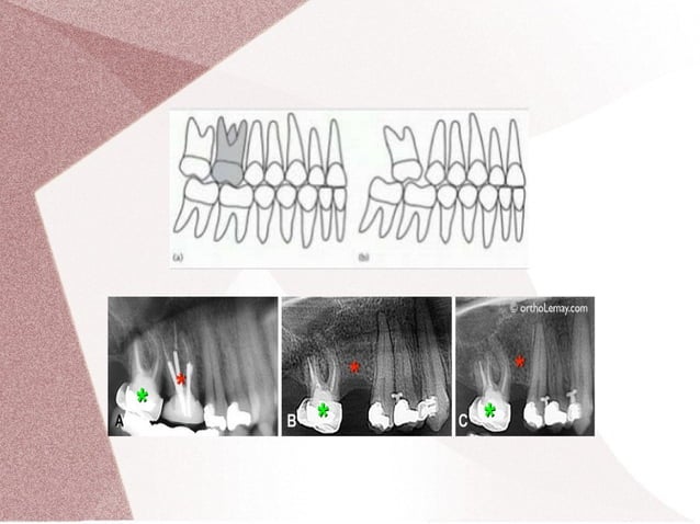 Extraction Of The First Permanent Molar | ODP | Dental Health ...