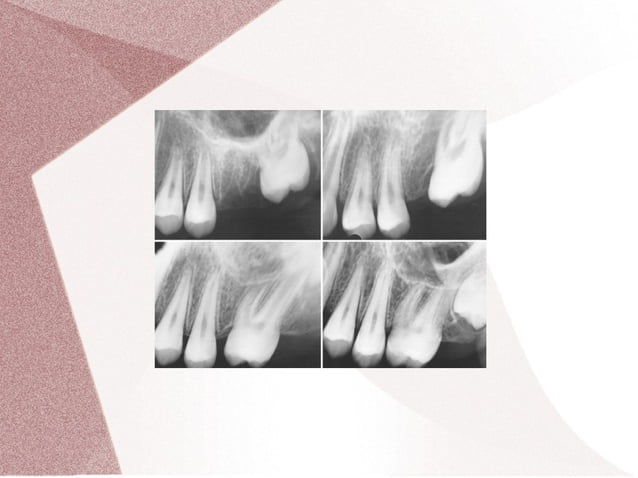 Extraction Of The First Permanent Molar | ODP | Dental Health ...