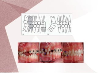 Extraction Of The First Permanent Molar | ODP