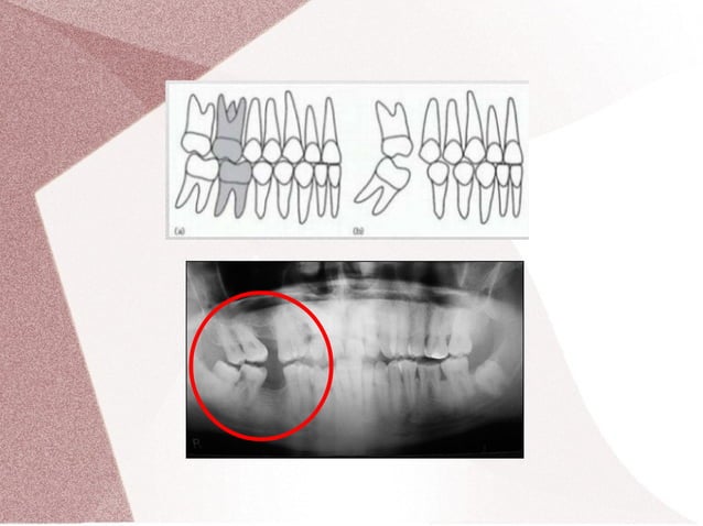 Extraction Of The First Permanent Molar | ODP | Dental Health ...