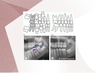 Extraction Of The First Permanent Molar | ODP