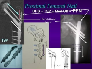 Pfn biomechanics | PPT