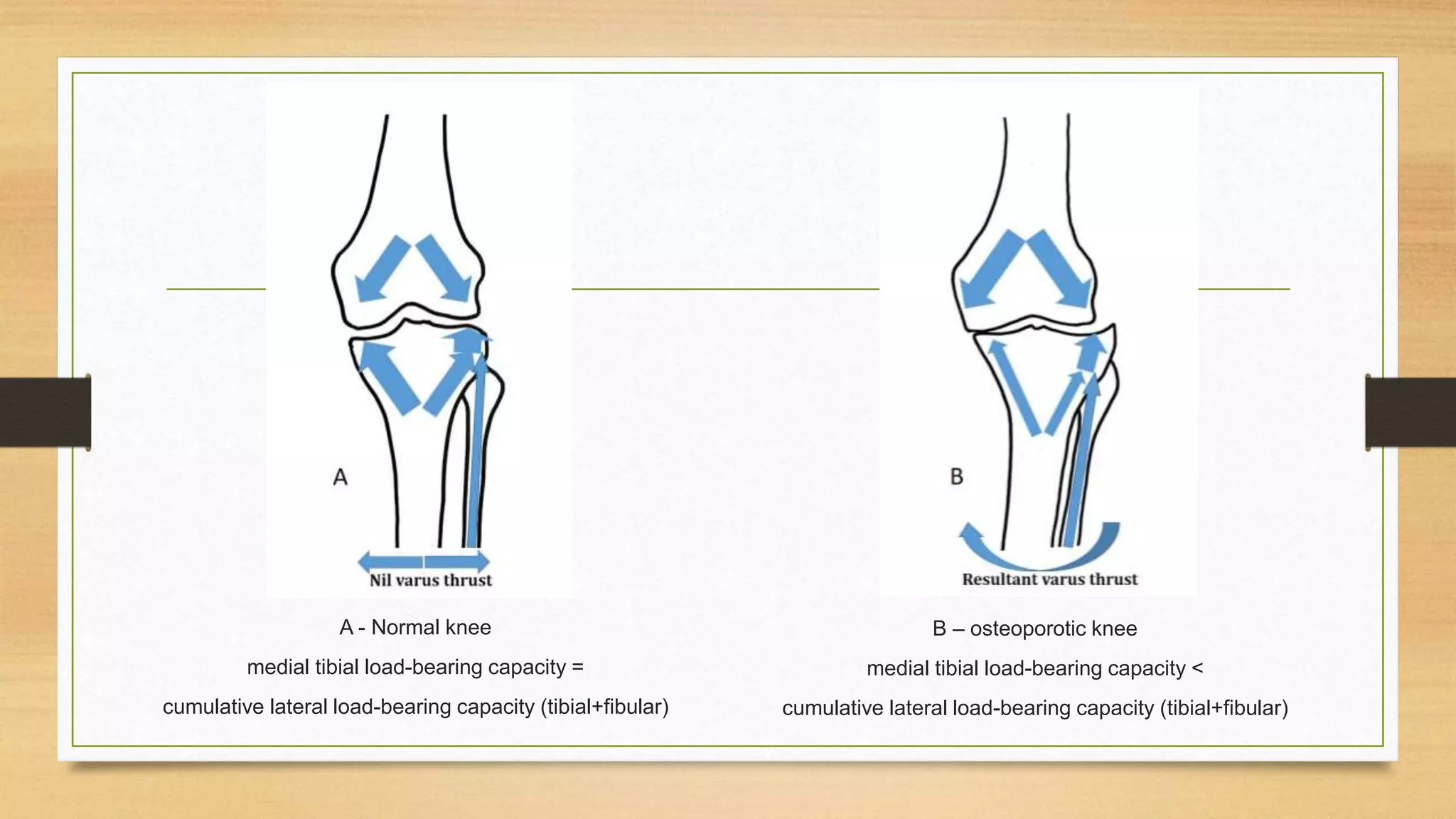 Proximal Fibular Osteotomy for Knee Osteoarthritis - What is the ...