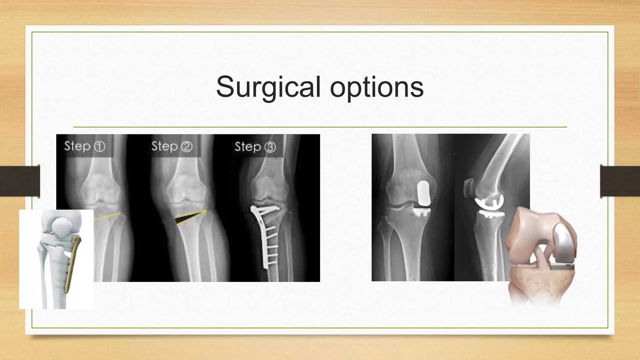 Proximal Fibular Osteotomy for Knee Osteoarthritis - What is the ...