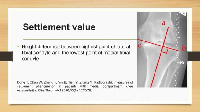 Proximal Fibular Osteotomy for Knee Osteoarthritis - What is the ...