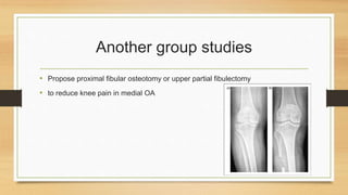 Proximal Fibular Osteotomy for Knee Osteoarthritis - What is the ...