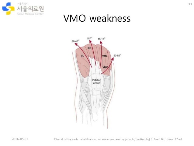 Patellofemoral Pain Syndrome