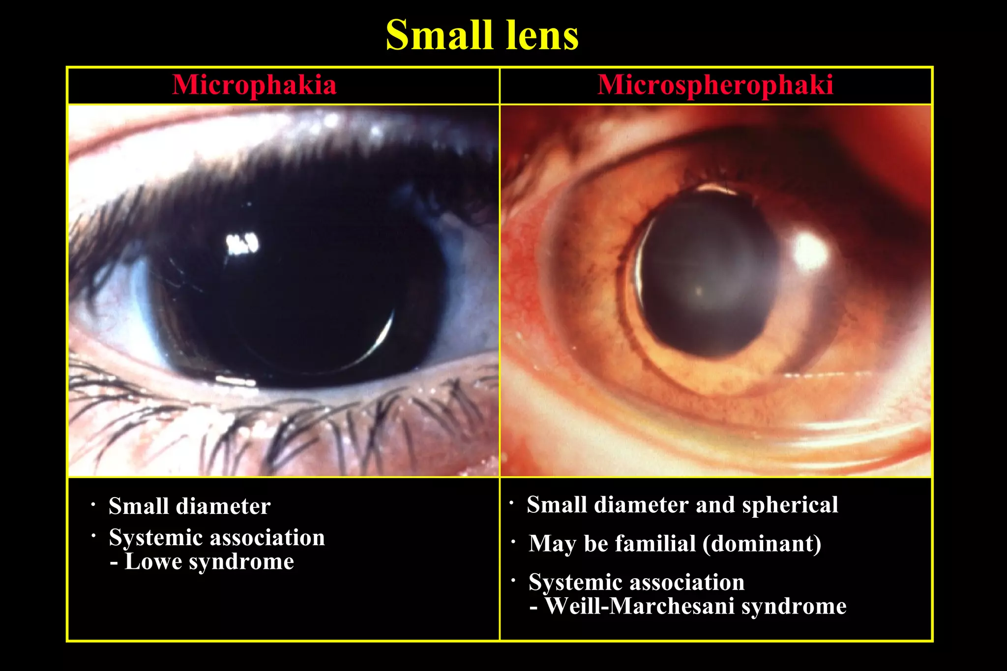 25 abnormal lens shape | PPT