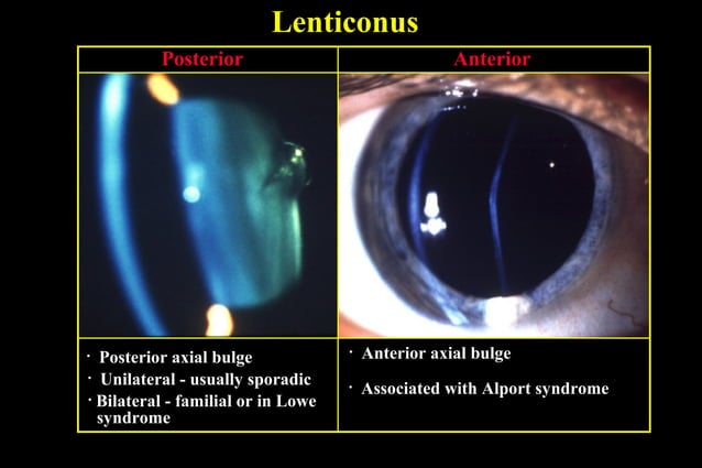 25 abnormal lens shape | PPT | Eye and Vision Conditions | Diseases and ...