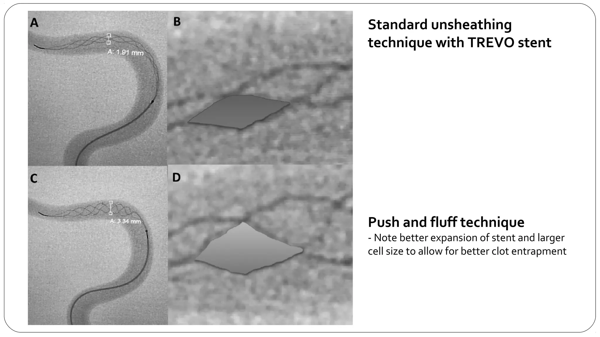 Push and Puff Technique for Mechanical Thrombectomy | PPT