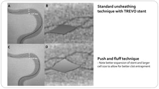 Push and Puff Technique for Mechanical Thrombectomy | PPT