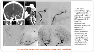 Push and Puff Technique for Mechanical Thrombectomy | PPT