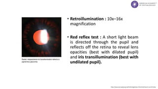 Secondary Glaucoma, PES, Management of SG | PPTX