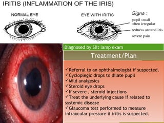 Parts of eys-Iris | PPT