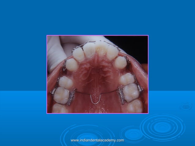 Pg canine retraction spring | PPT | Geology | Science