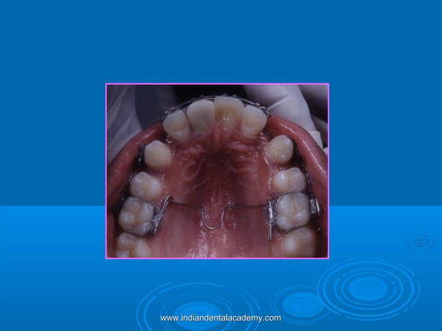 Pg canine retraction spring | PPT | Geology | Science
