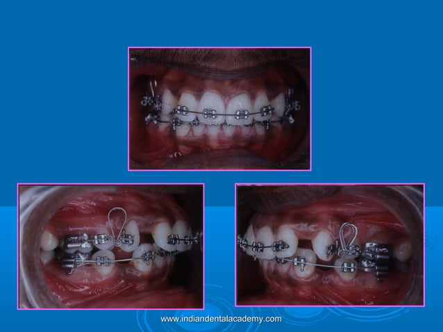 Pg canine retraction spring | PPT | Geology | Science