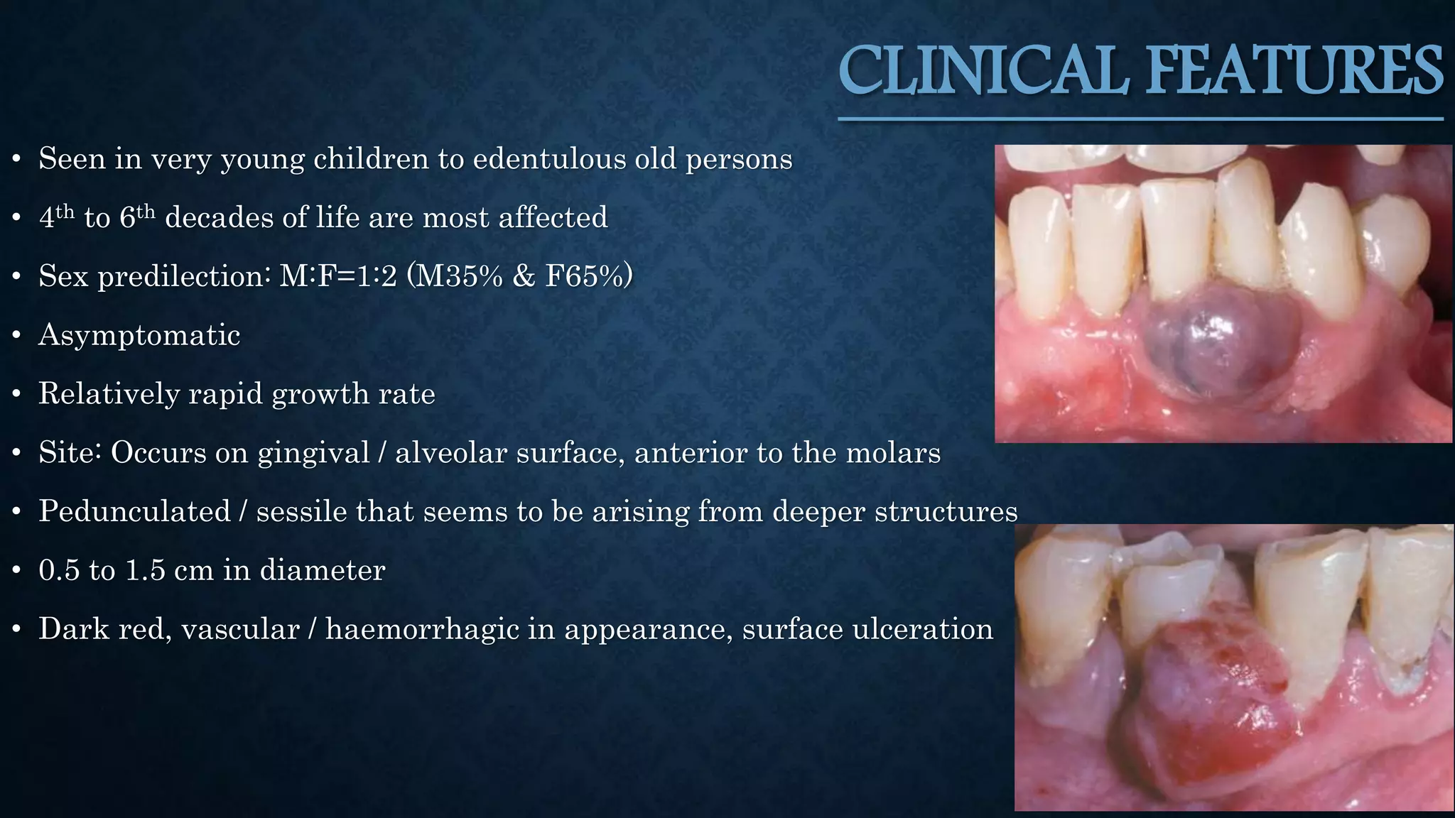 peripheral giant cell granuloma of oral cavity | PPTX