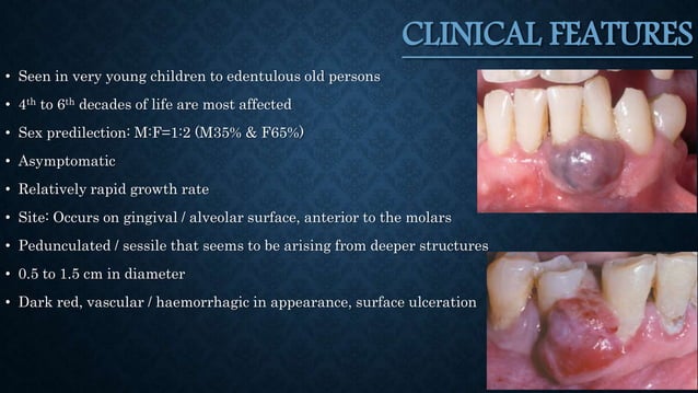 peripheral giant cell granuloma of oral cavity | PPTX | Dental Health ...