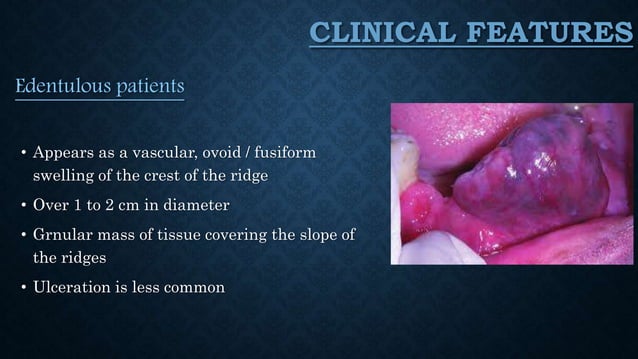 peripheral giant cell granuloma of oral cavity | PPTX | Dental Health ...
