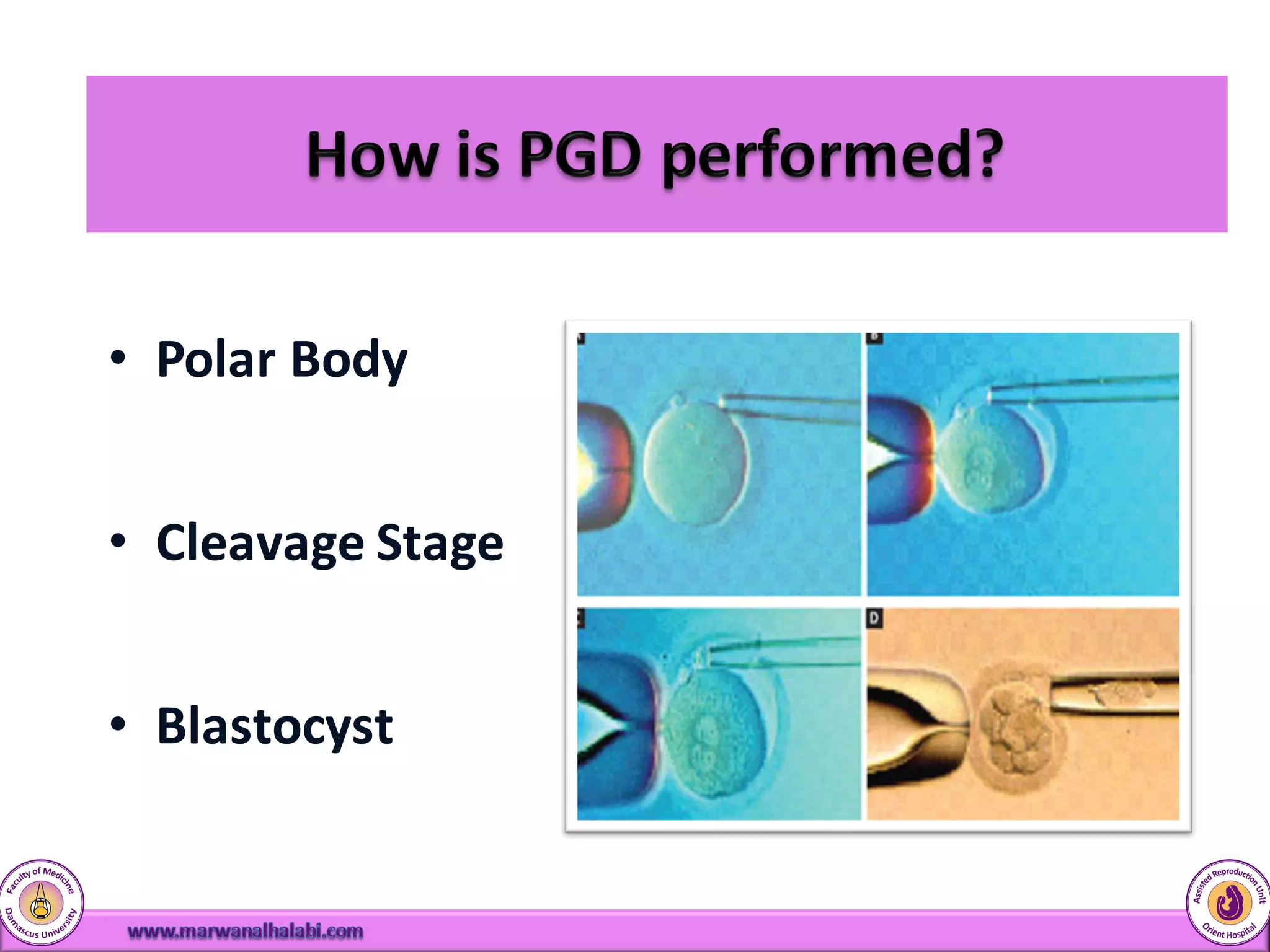 Pre-implantation Genetic Diagnosis ( PGD ) | PDF