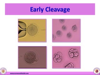 Pre-implantation Genetic Diagnosis ( PGD ) | PDF