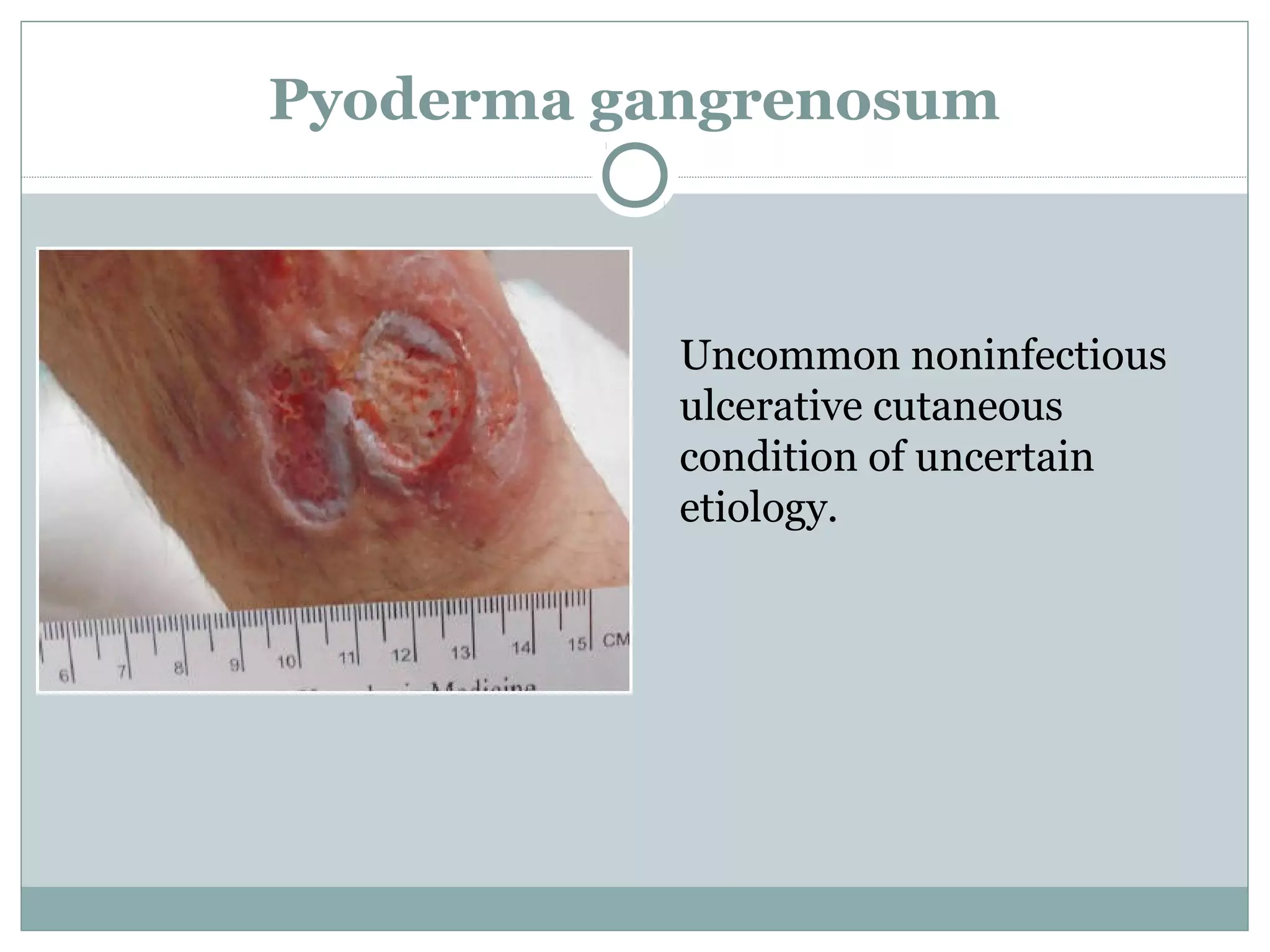 Pyoderma Gangrenosum Ppt