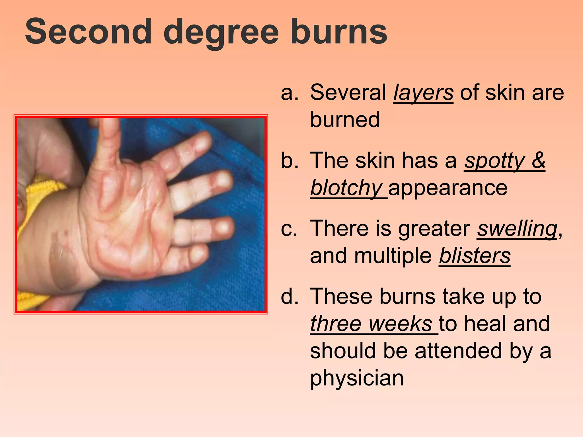 BURNS-its pathophysiology, fluid management and its surgical management ...