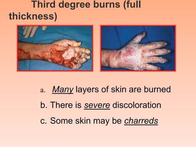BURNS-its pathophysiology, fluid management and its surgical management ...