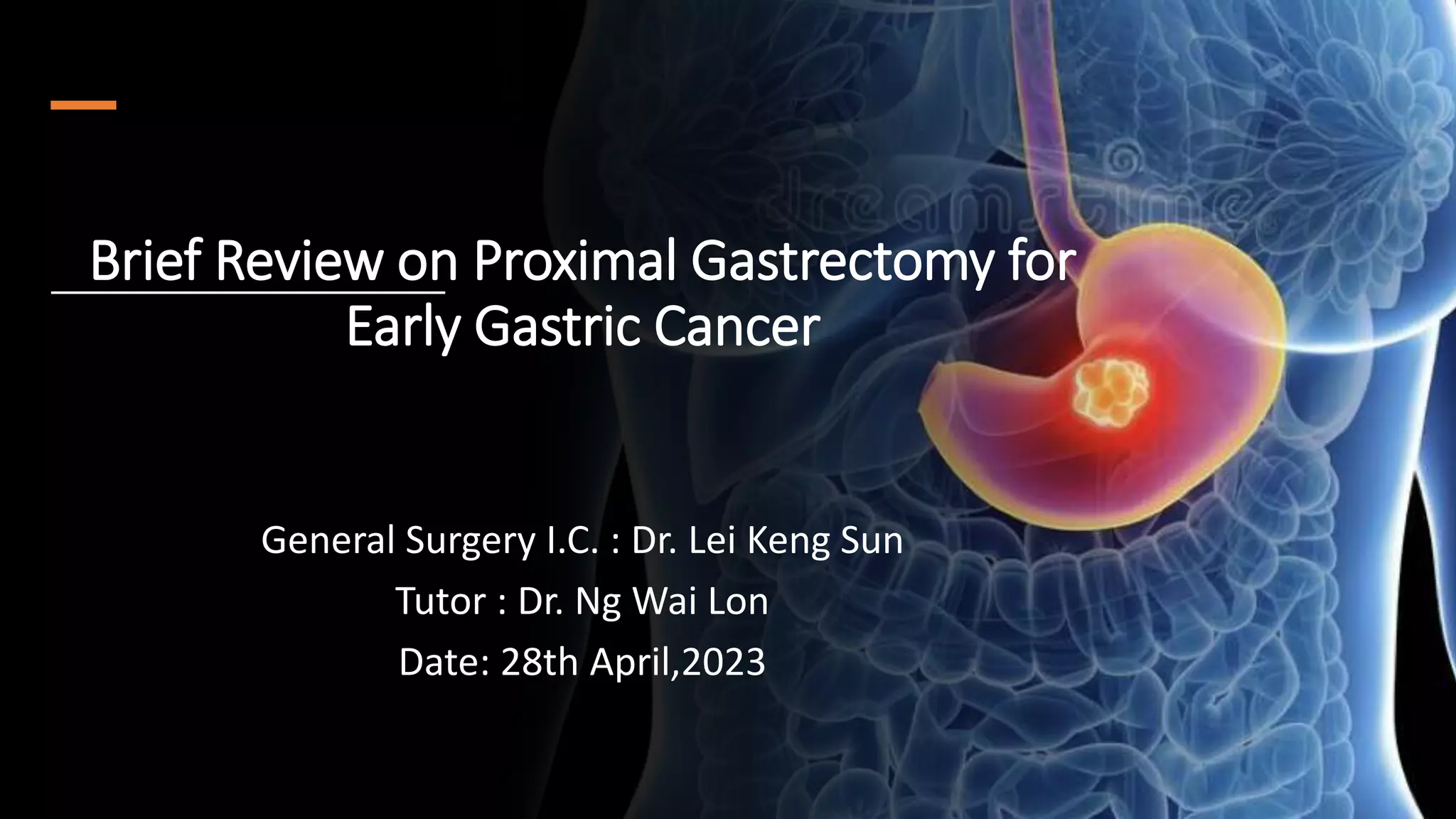 Proximal Gastrectomy for Early Gastric Cancer | PPTX