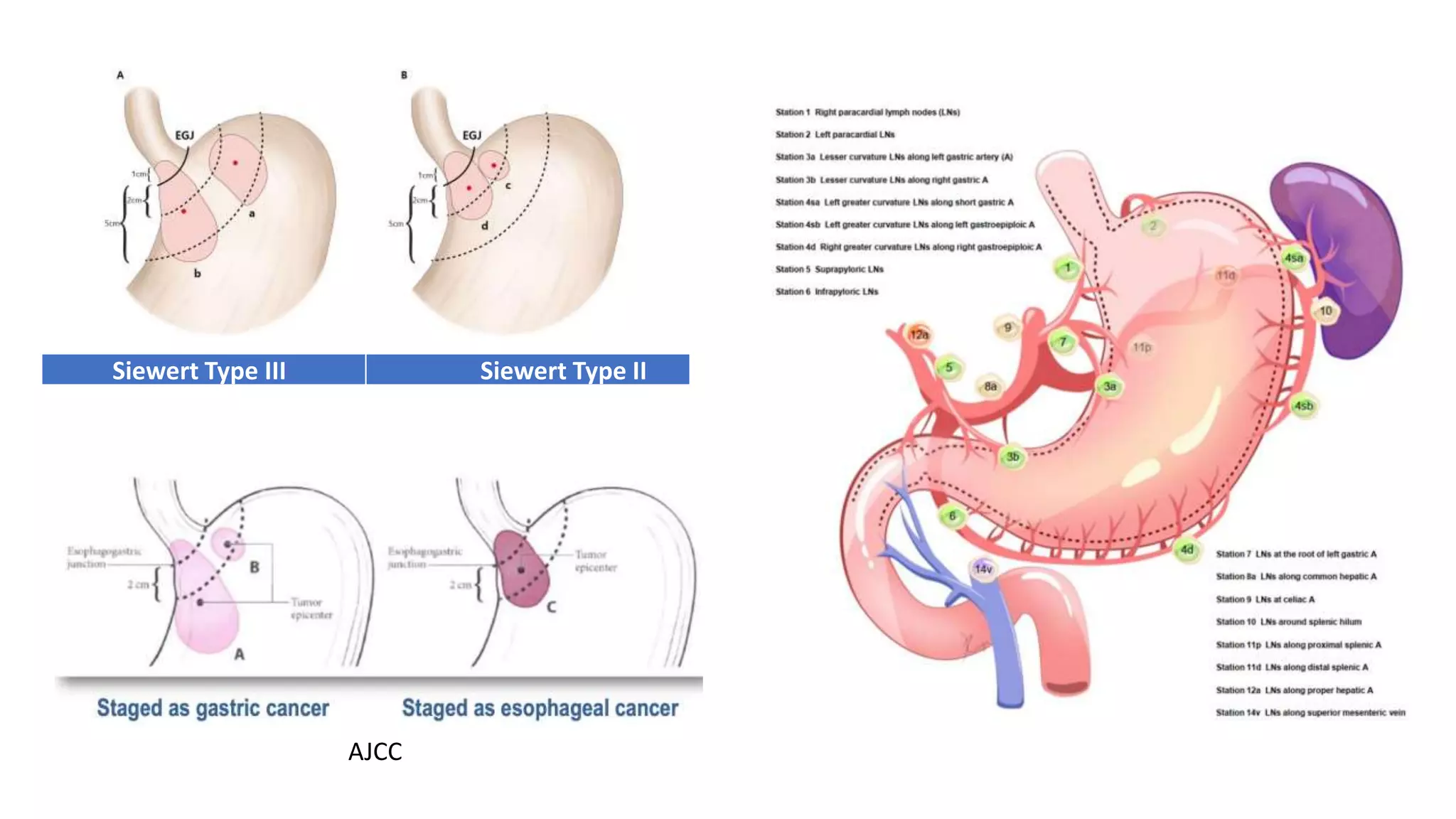 Proximal Gastrectomy for Early Gastric Cancer | PPTX