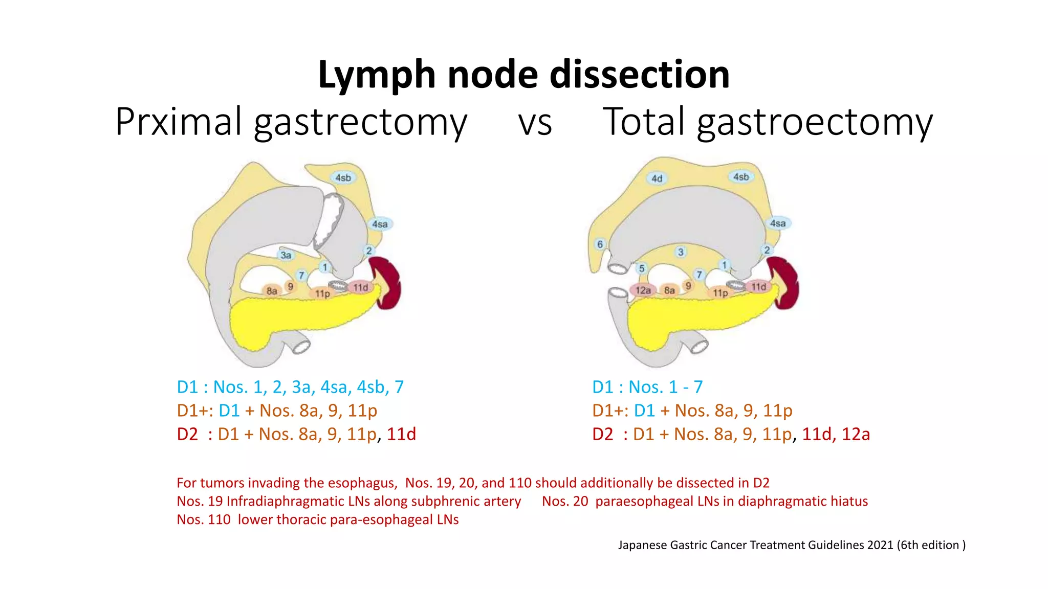 Proximal Gastrectomy for Early Gastric Cancer | PPTX