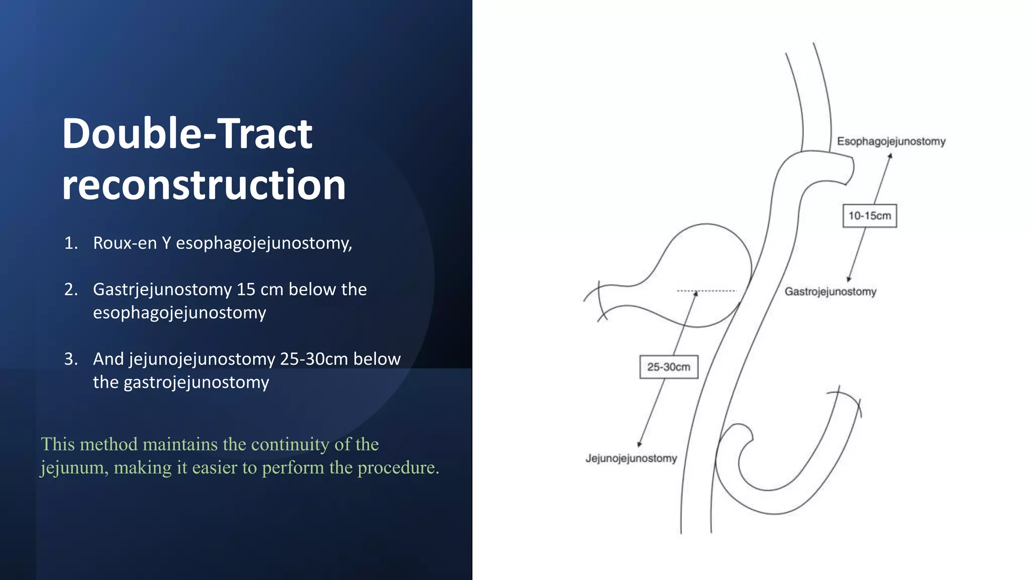 Proximal Gastrectomy for Early Gastric Cancer | PPTX