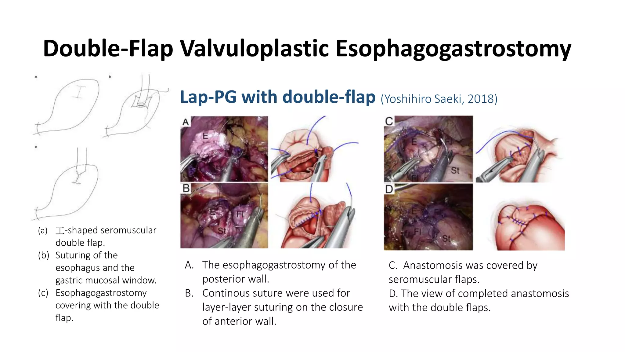 Proximal Gastrectomy for Early Gastric Cancer | PPTX