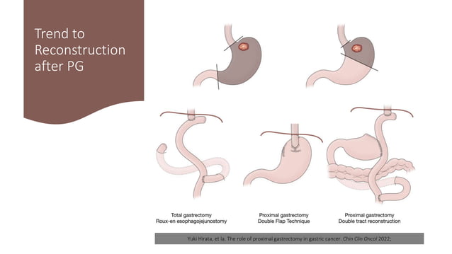 Proximal Gastrectomy for Early Gastric Cancer | PPTX